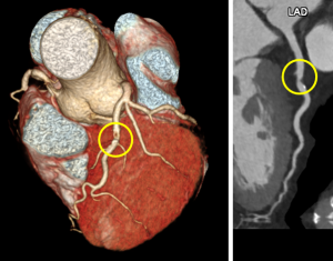 FFRct解析検査 - 倉敷中央病院 心臓病センター 循環器内科