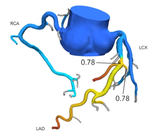 FFRct解析検査 - 倉敷中央病院 心臓病センター 循環器内科