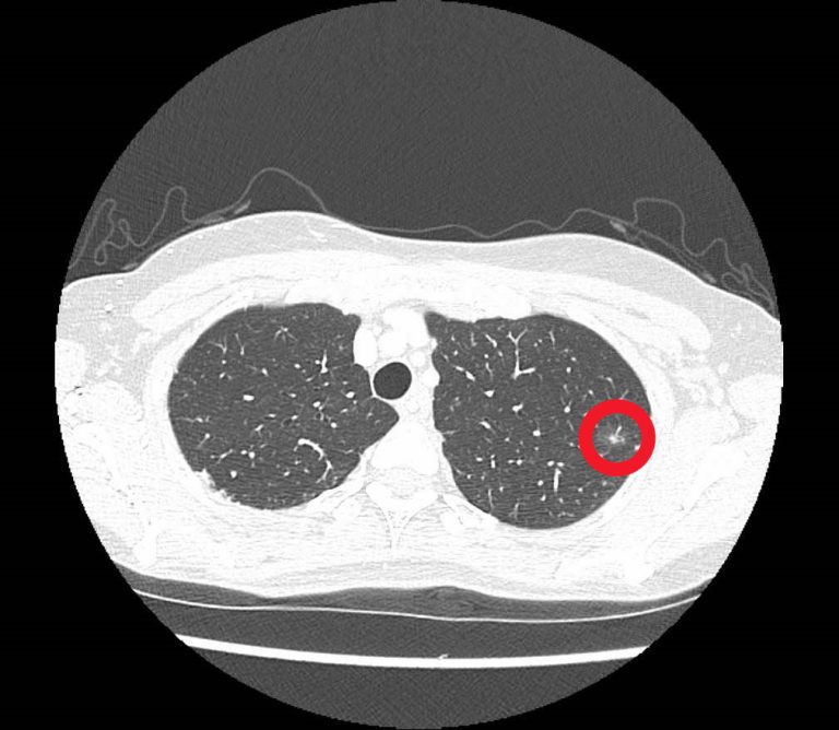 VAL-MAP （Virtual Assisted Lung - Mapping） | 呼吸器外科 | 倉敷中央病院